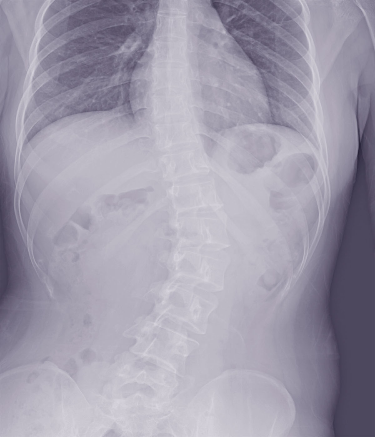 Scoliosis - Osana